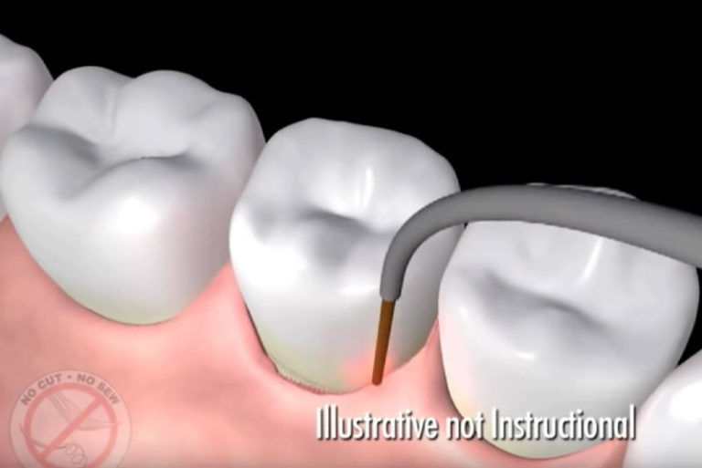 Periodontist in Wilmington, NC LANAP Laser Gum Surgery